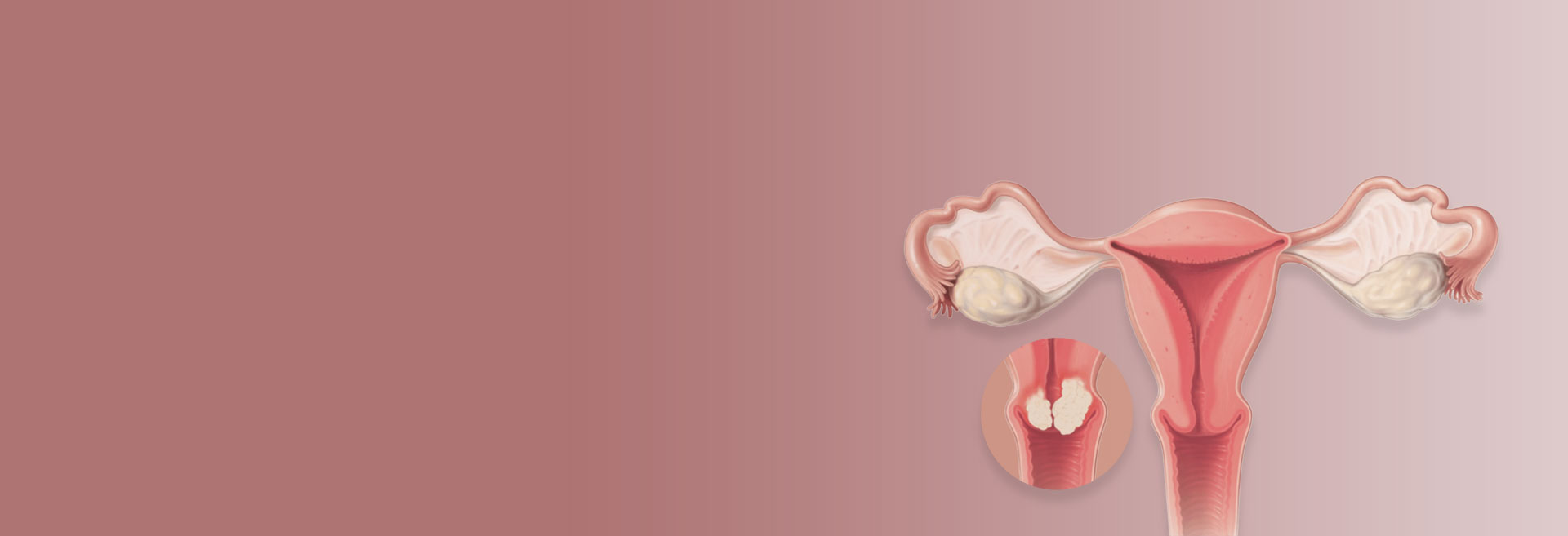 Câncer de Colo do Útero - Clínica da Mulher